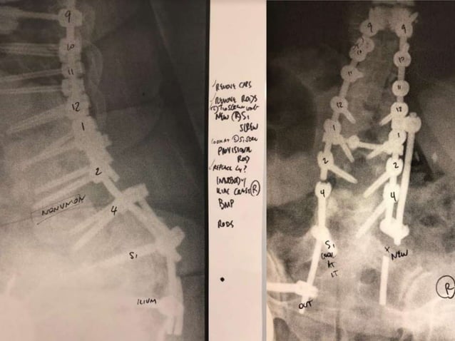 Nonunion PSO pedicle subtraction osteotomy | PPTX