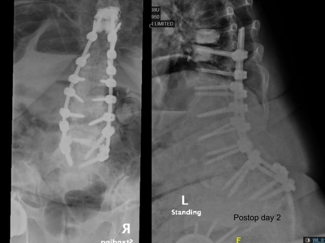 Nonunion PSO pedicle subtraction osteotomy | PPTX
