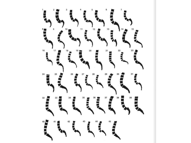 Nonunion PSO pedicle subtraction osteotomy | PPTX