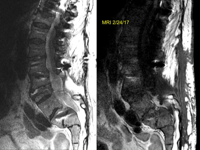 Nonunion PSO pedicle subtraction osteotomy | PPTX