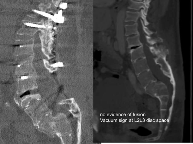 Nonunion PSO pedicle subtraction osteotomy | PPTX
