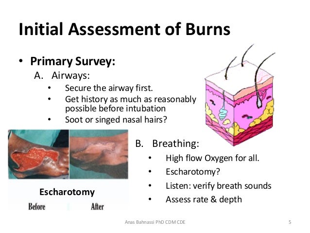 Lecture four burns first Aid