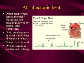 Atrial And Ventricular Ectopy