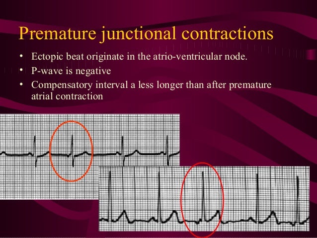 Heart pathology
