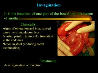Intestinal obstruction | PPT