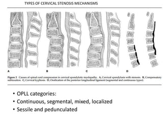 Posterior cervical laminoplasty for stenosis | PPTX