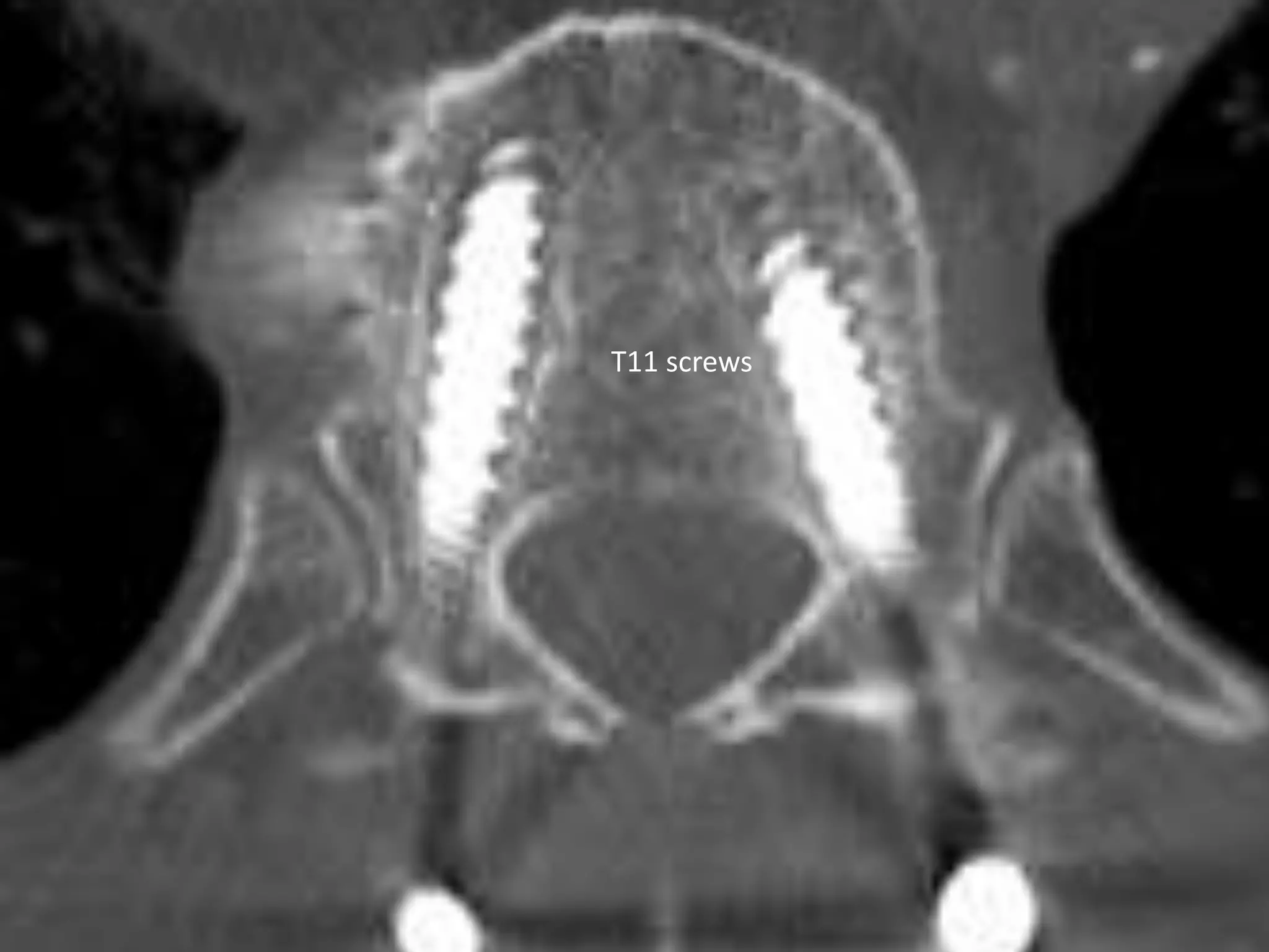 Spine Lecture recurrent metastatic lesion spine recurrence 2019 april | PPT
