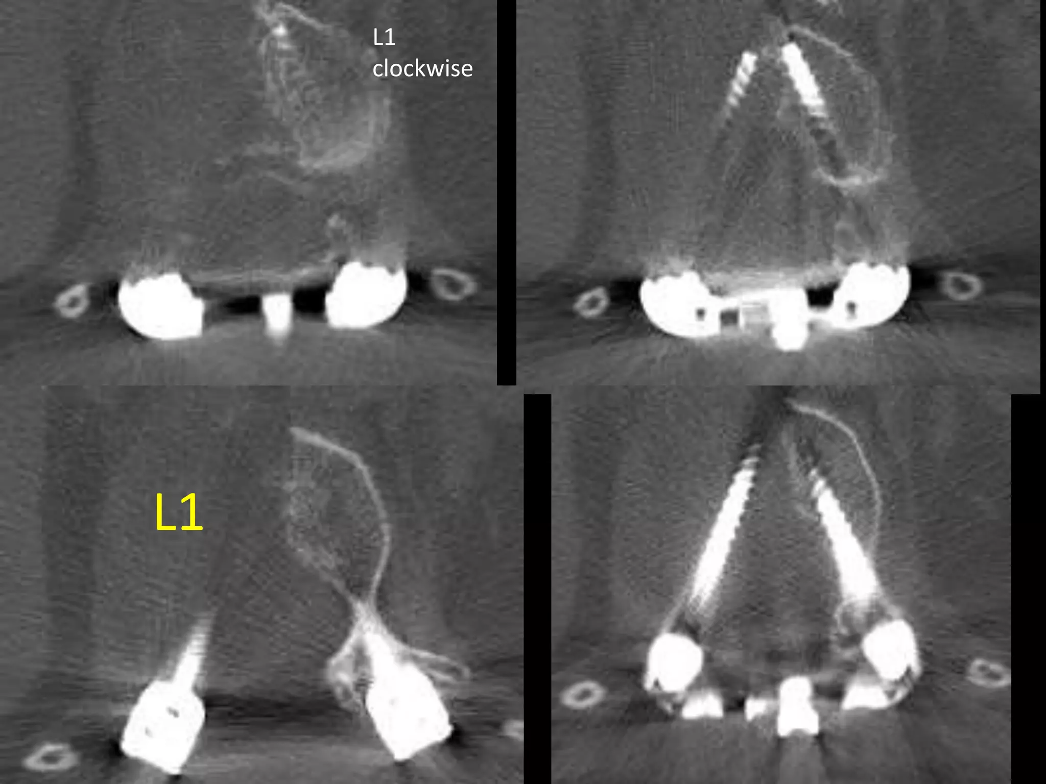 Spine Lecture recurrent metastatic lesion spine recurrence 2019 april | PPT