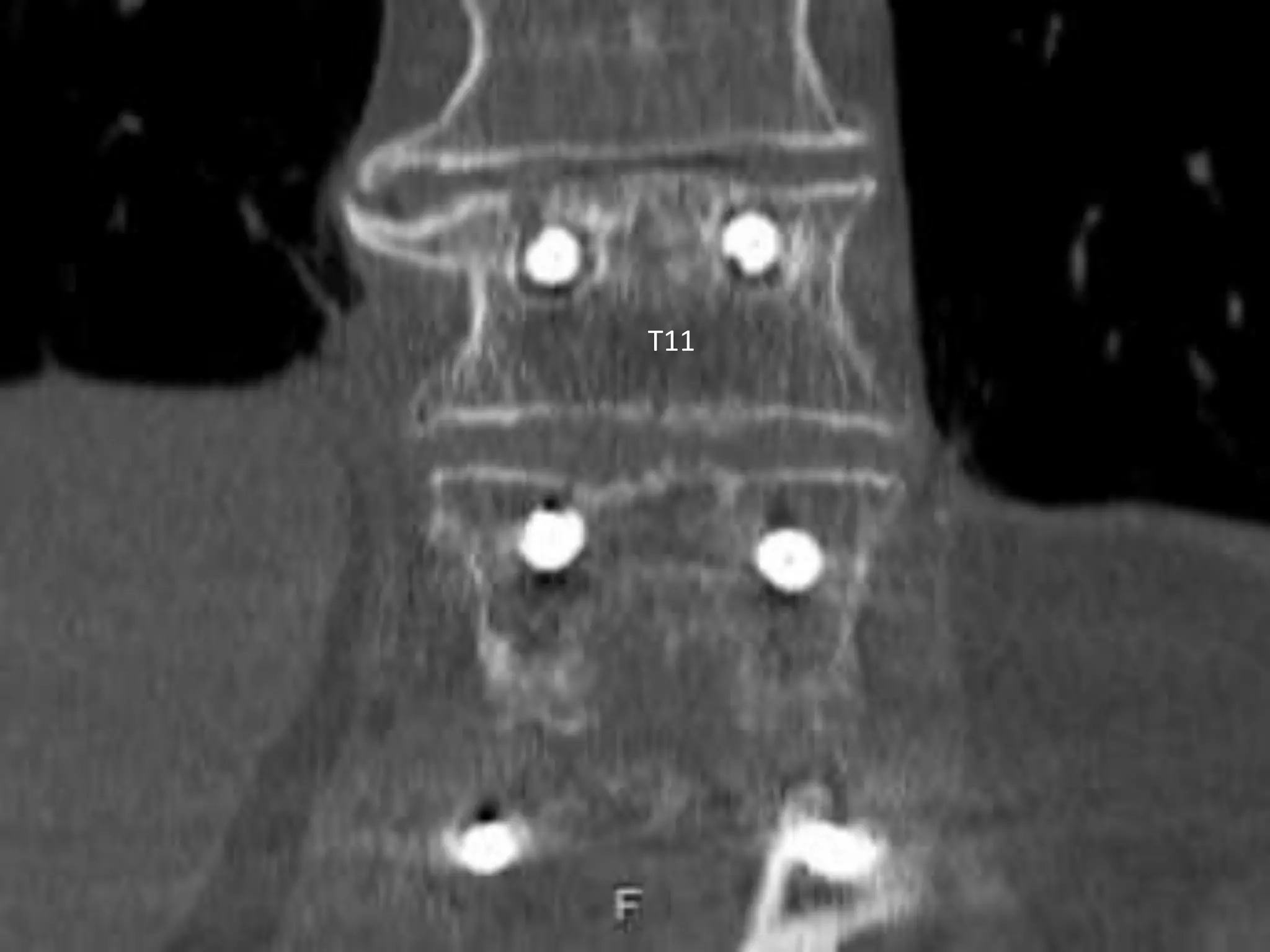 Spine Lecture recurrent metastatic lesion spine recurrence 2019 april | PPT