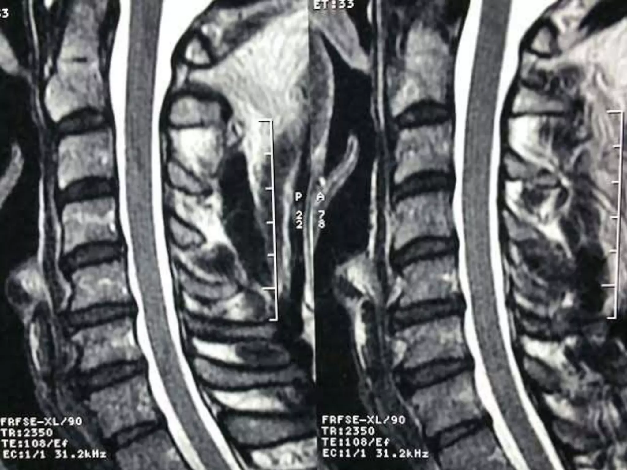How to read a cervical MRI | PPTX