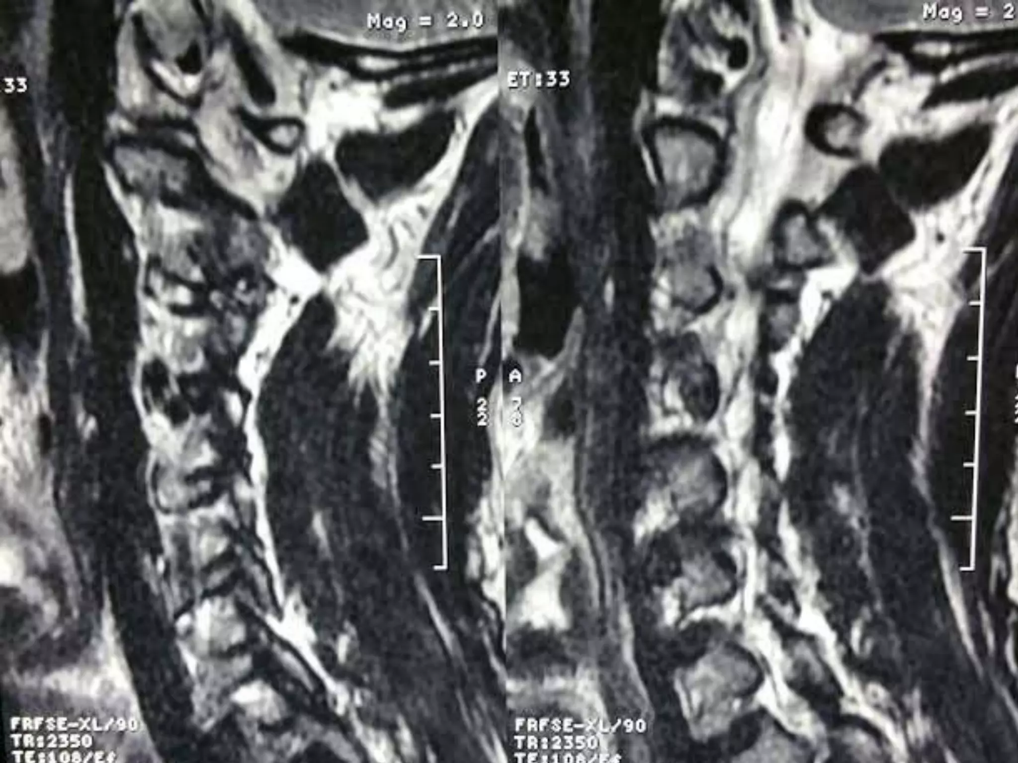 How to read a cervical MRI | PPTX