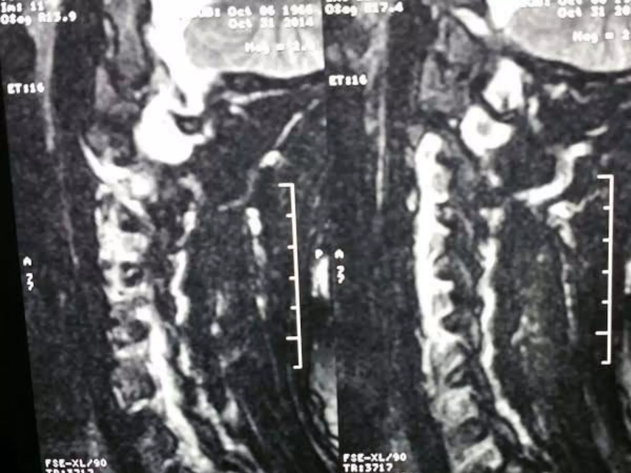 How to read a cervical MRI | PPTX