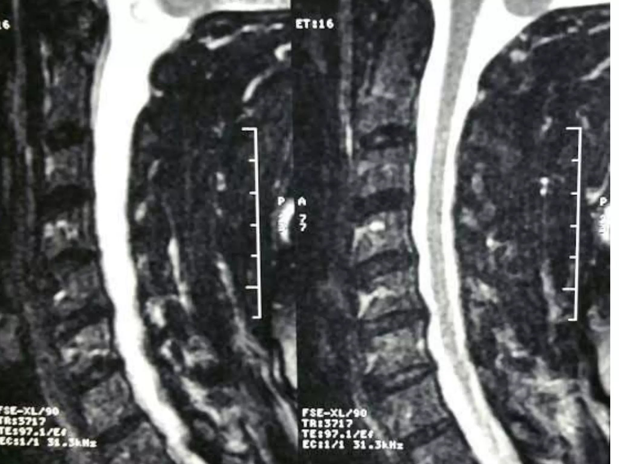 How to read a cervical MRI | PPTX