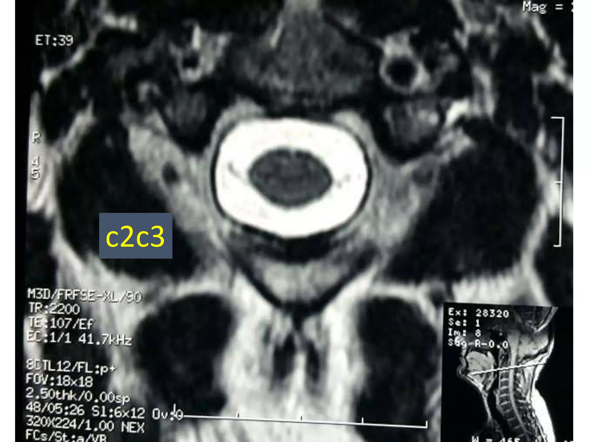 How to read a cervical MRI | PPTX