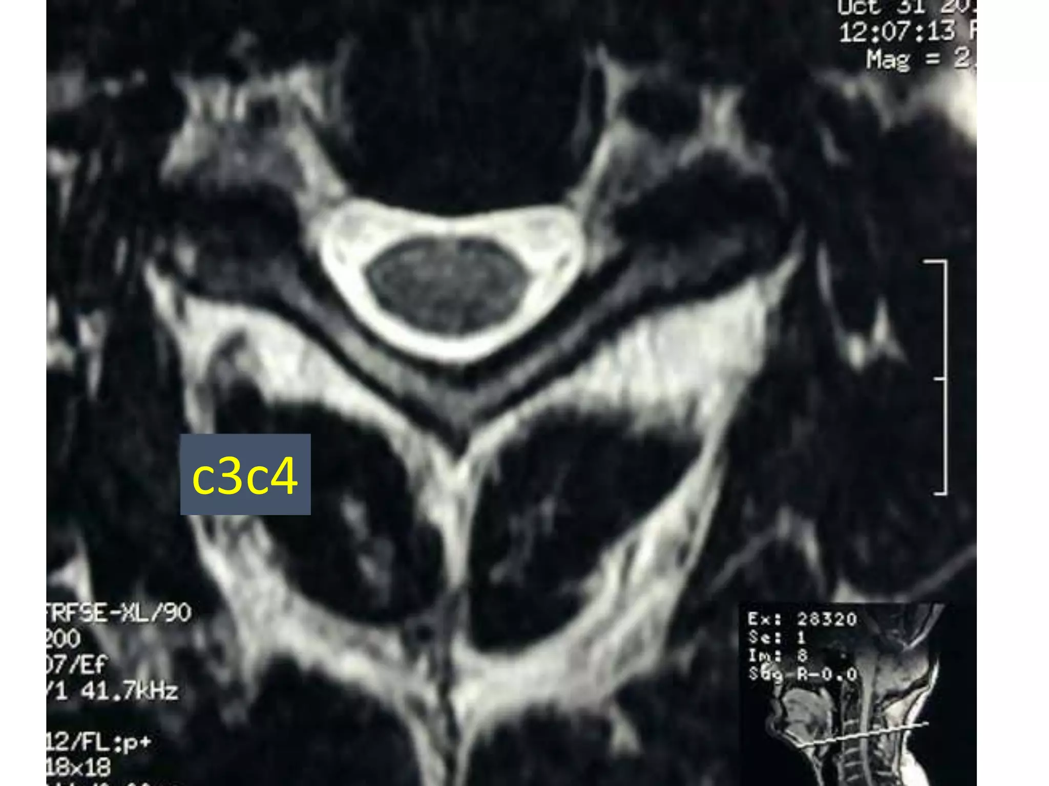 How to read a cervical MRI | PPTX