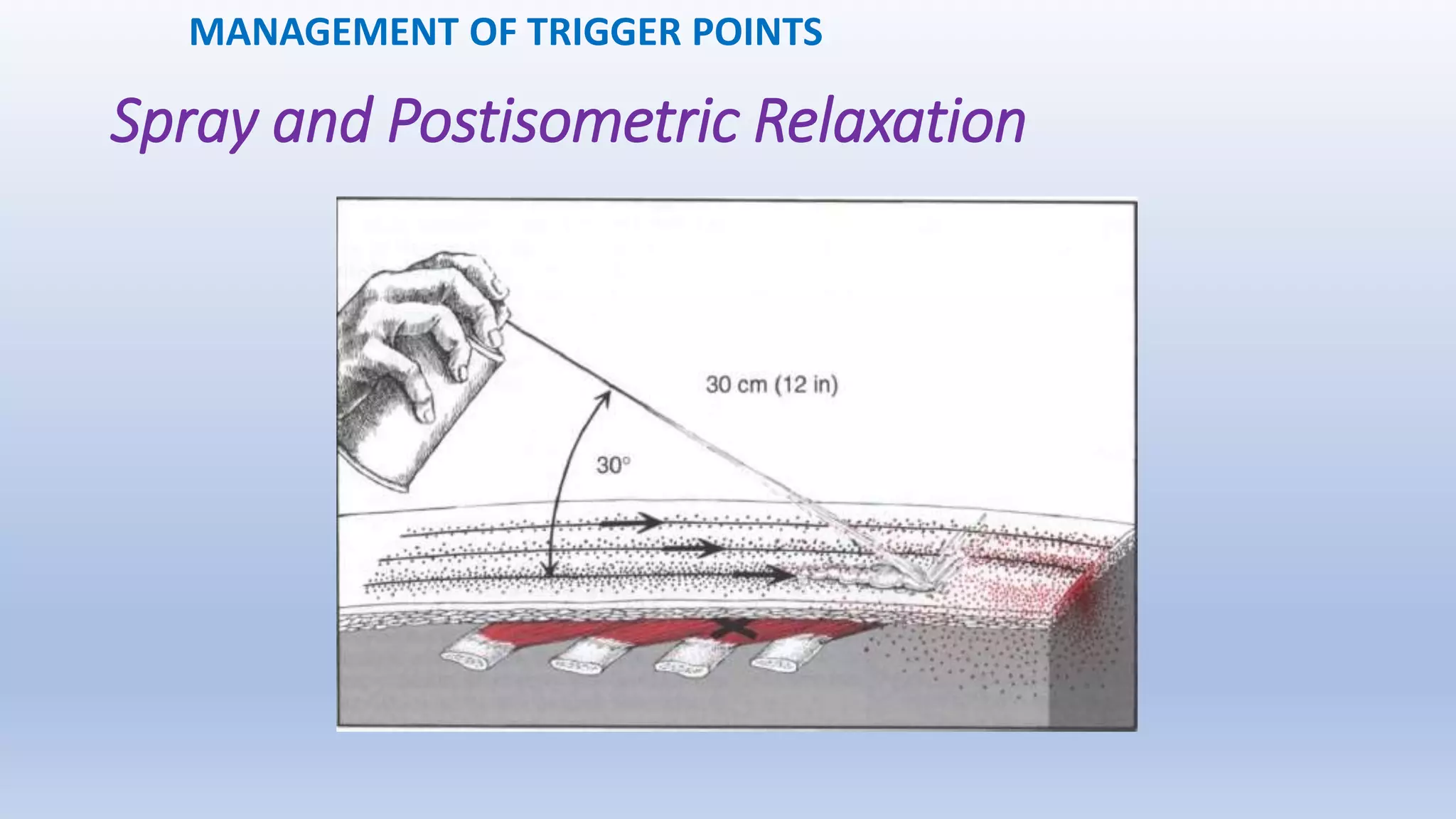 Trigger and tender points.pptx | First Aid | Injuries