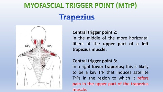 Trigger and tender points.pptx | First Aid | Injuries