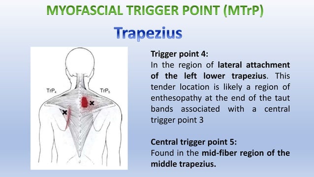 Trigger and tender points.pptx | First Aid | Injuries