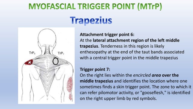 Trigger and tender points.pptx | First Aid | Injuries