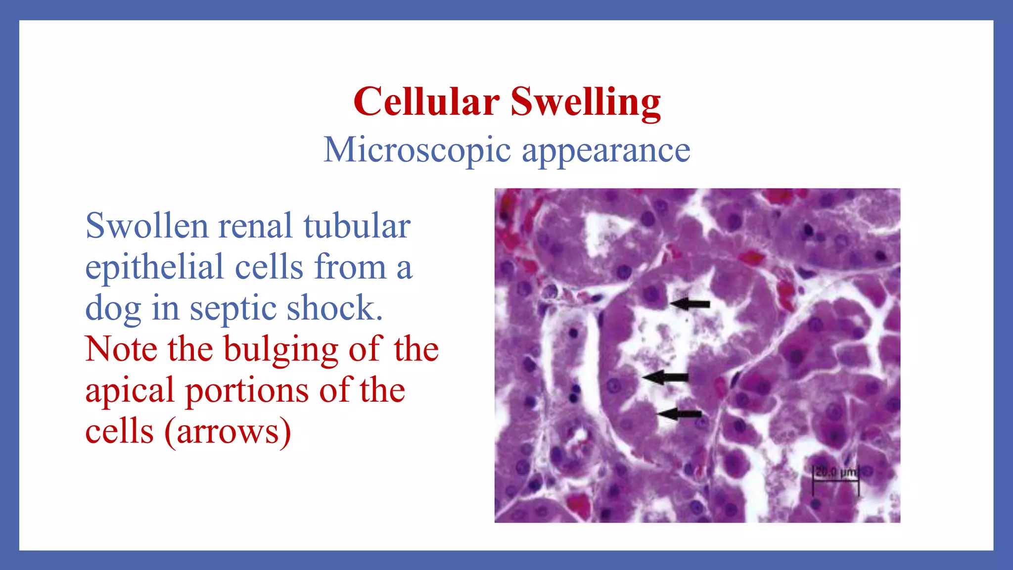 Difference between reversible and irreversible cell injury,Mechanism of ...