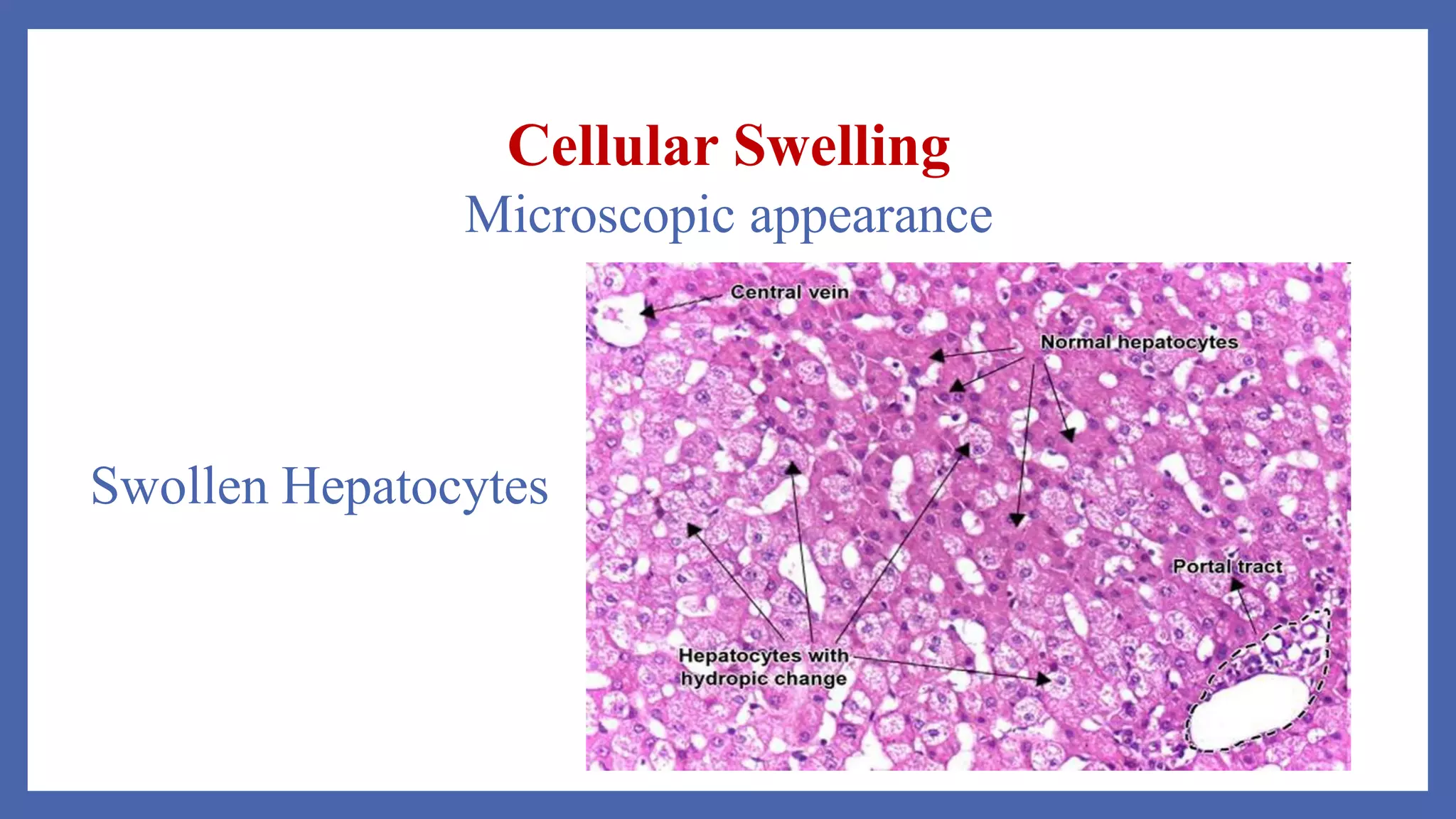 Difference between reversible and irreversible cell injury,Mechanism of ...