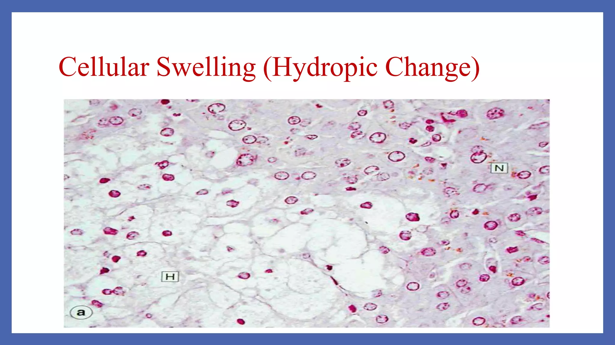 Difference between reversible and irreversible cell injury,Mechanism of ...