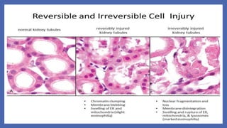 Difference between reversible and irreversible cell injury,Mechanism of ...