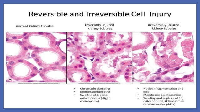 Difference between reversible and irreversible cell injury,Mechanism of cell injury and types of ...