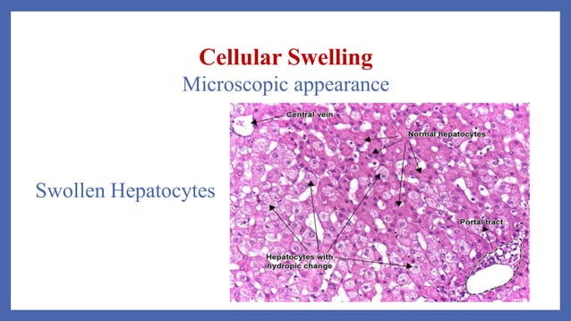 Difference between reversible and irreversible cell injury,Mechanism of ...
