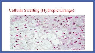 Difference between reversible and irreversible cell injury,Mechanism of ...