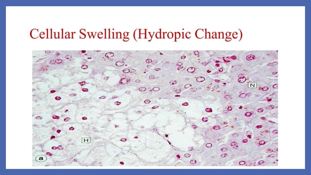 Difference between reversible and irreversible cell injury,Mechanism of ...