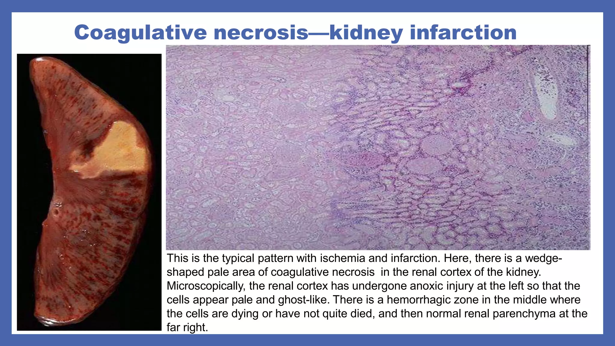 Difference between Apoptosis versus Necrosis and Types of Necrosis.pptx