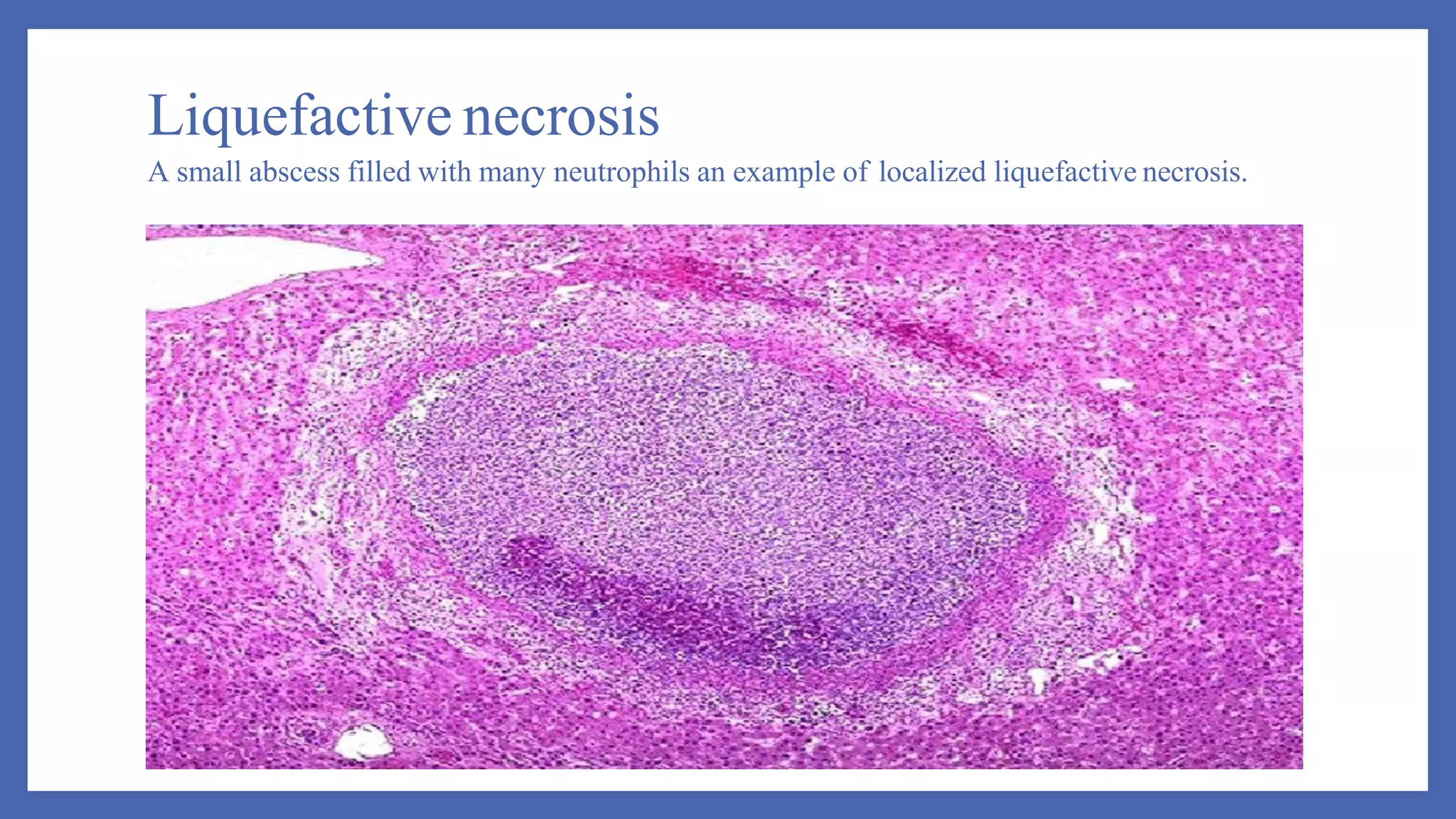 Difference between Apoptosis versus Necrosis and Types of Necrosis.pptx