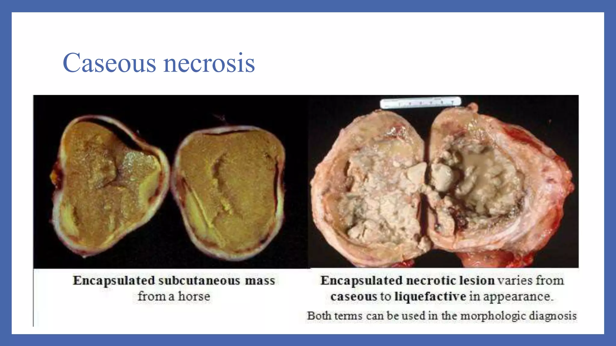 Difference between Apoptosis versus Necrosis and Types of Necrosis.pptx