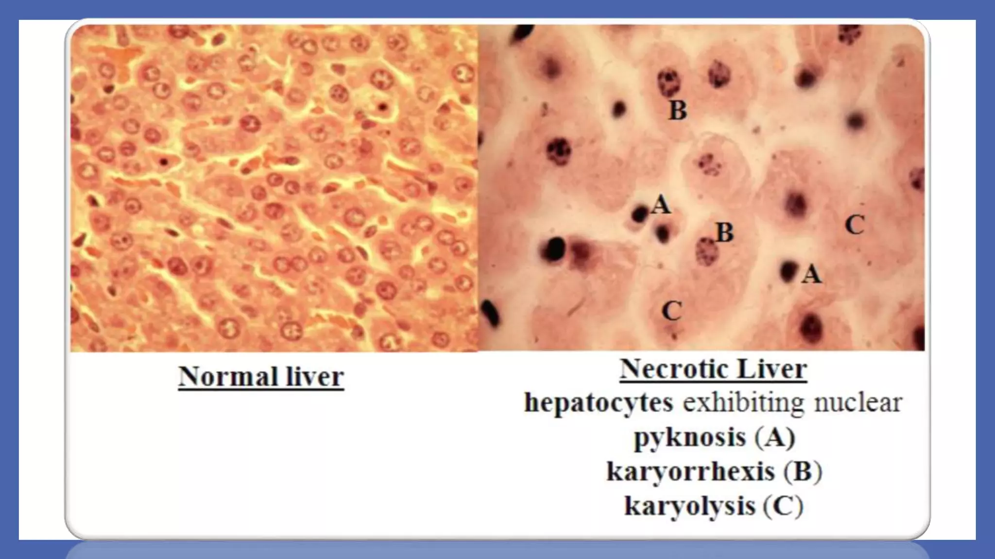 Difference between Apoptosis versus Necrosis and Types of Necrosis.pptx