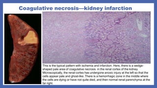 Difference between Apoptosis versus Necrosis and Types of Necrosis.pptx