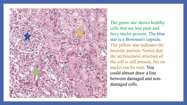Difference between Apoptosis versus Necrosis and Types of Necrosis.pptx