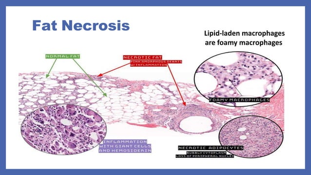 Difference between Apoptosis versus Necrosis and Types of Necrosis.pptx