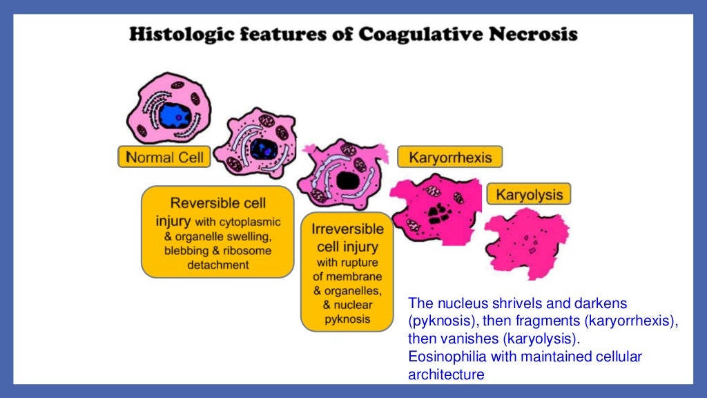Difference between Apoptosis versus Necrosis and Types of Necrosis.pp…