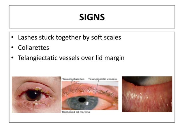 Lecture on Blepharitis , Stye & Chalazion For 4th Year MBBS ...
