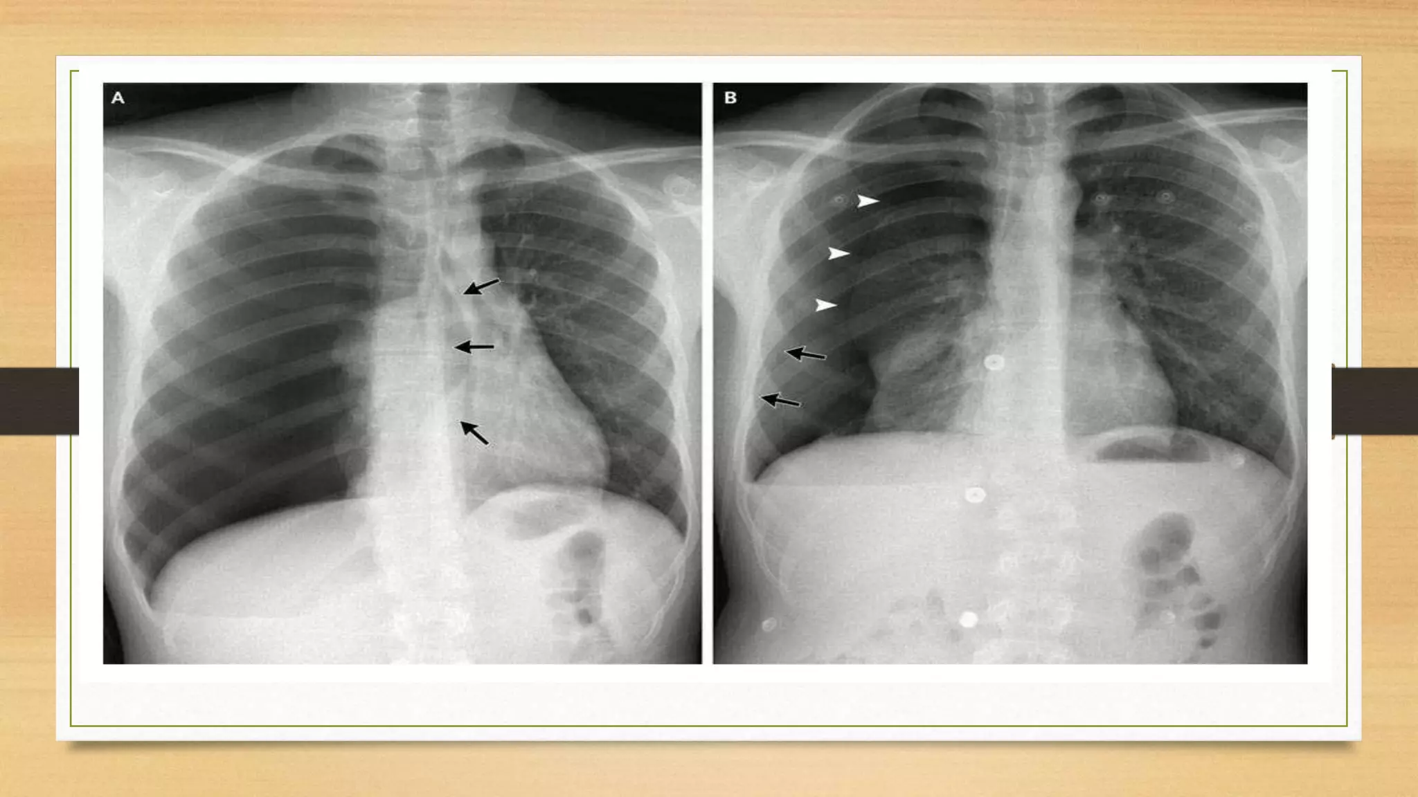Lecture on chest tube insertion | PPTX