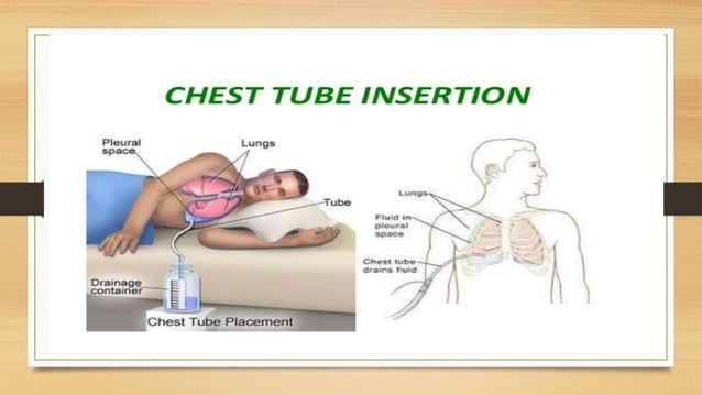Lecture on chest tube insertion | PPTX