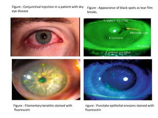 Lecture on Composition of Tear Film & Dry Eye For 4th Year MBBS ...