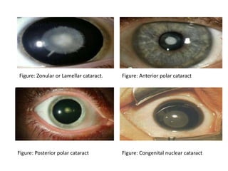Lecture on Congenital Cataract For 4th Year MBBS Undergraduate Students ...