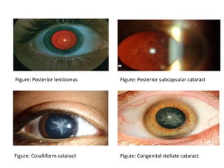 Lecture on Congenital Cataract For 4th Year MBBS Undergraduate Students ...