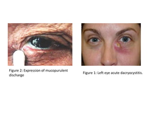 Lecture on Epiphora, Dacryocystitis For 4th Year MBBS Undergraduate ...