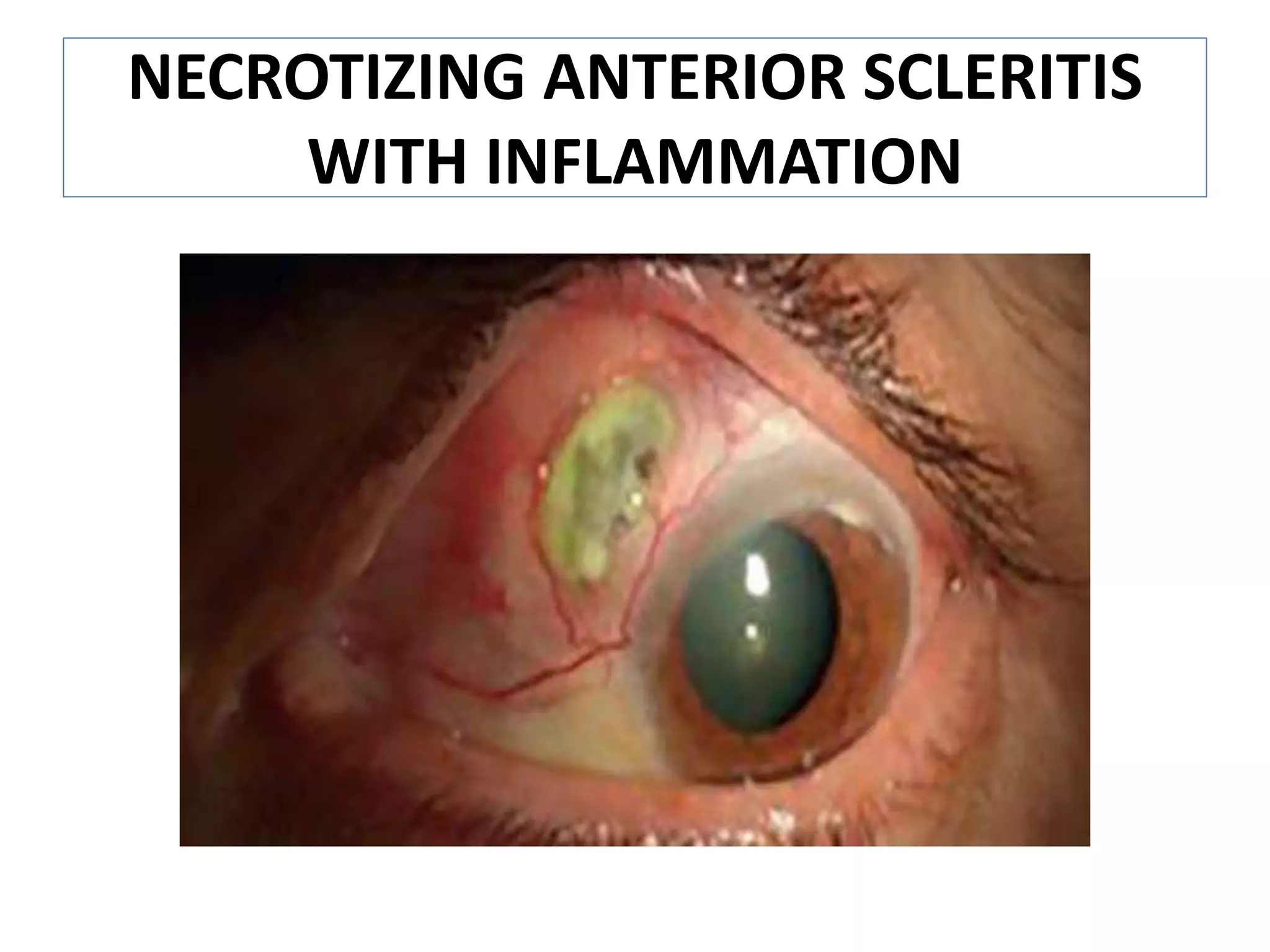 Lecture on Episcleritis & Scleritis For 4th Year MBBS Undergraduate ...