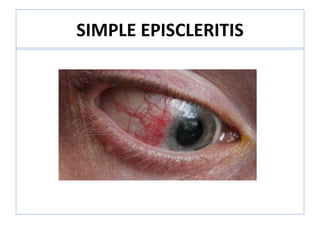 Simple Episcleritis