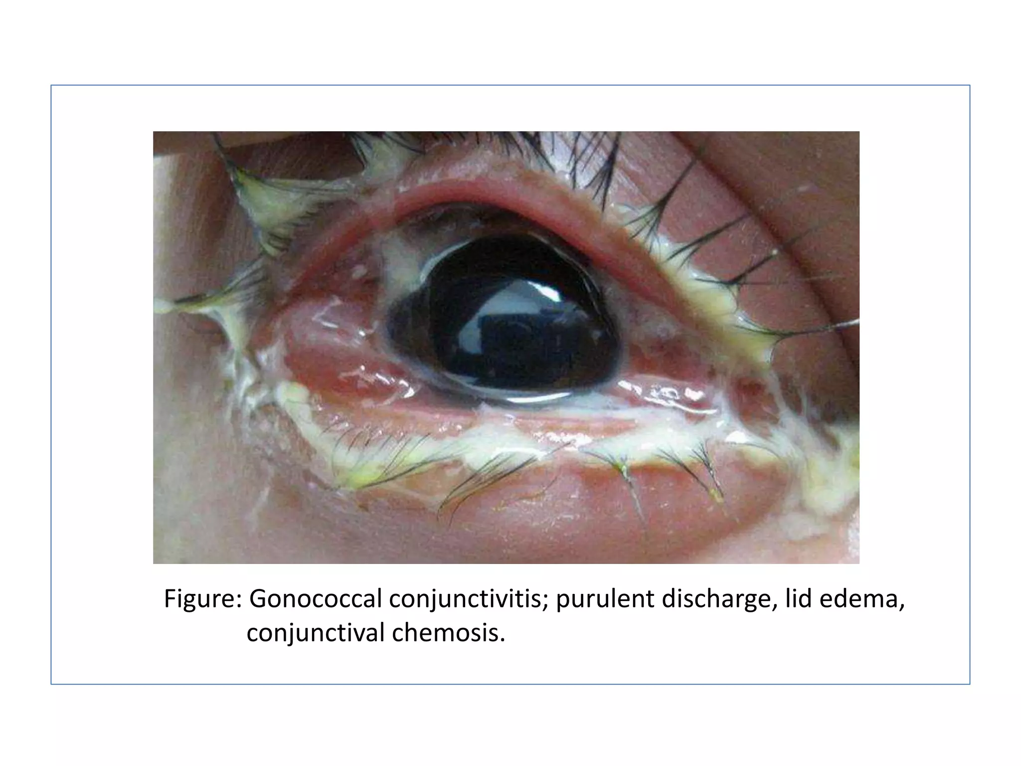 Lecture on Infective Conjunctivitis For 4th Year MBBS Undergraduate ...