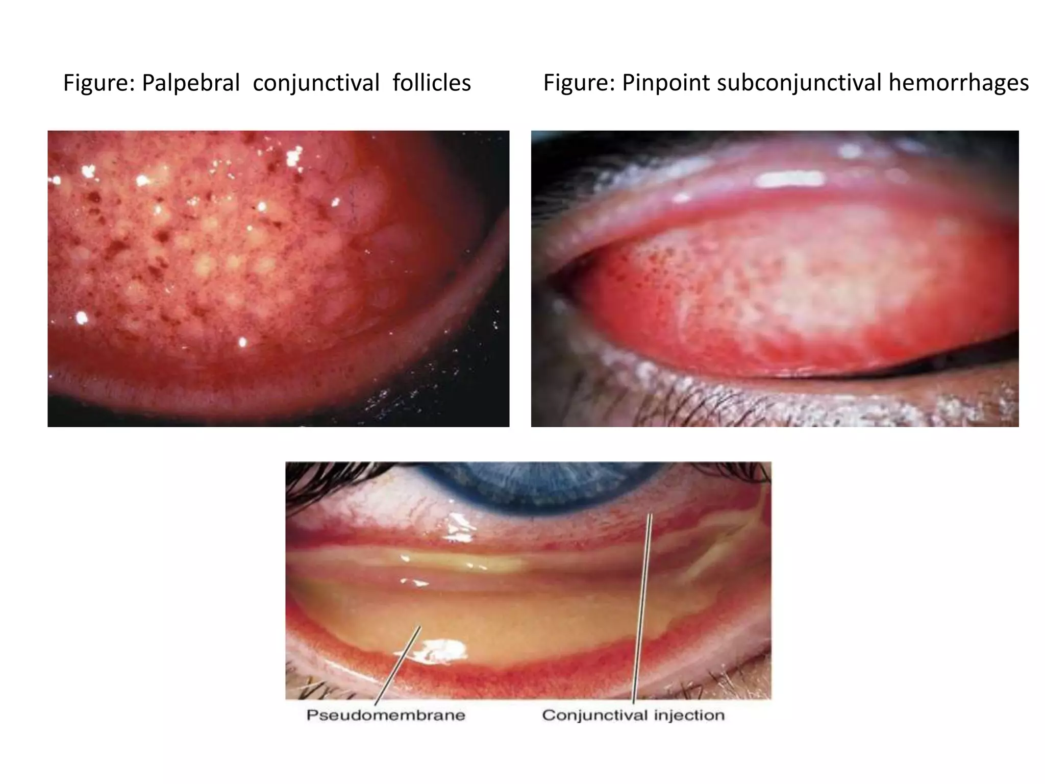 Lecture on Infective Conjunctivitis For 4th Year MBBS Undergraduate ...